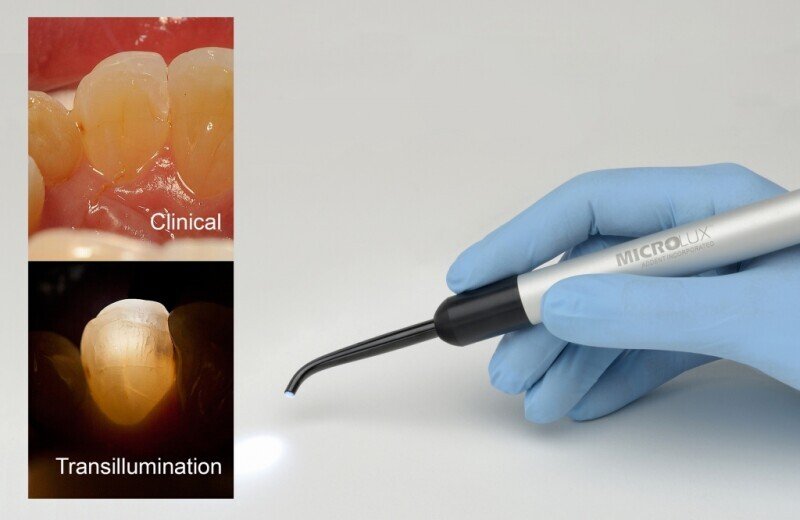 MICROLUX TRANSILLUMINATOR KIT 3MM | Curing Light | Aluro Equipment